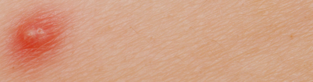 close up of pimple - acne support